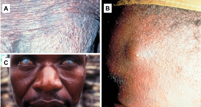 BugBitten Circulating nucleic acids for onchocerciasis detection: a ...