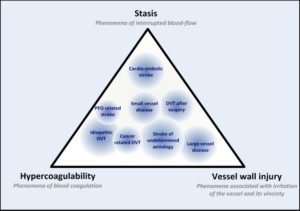 Virchow’s triad and lessons on the causes of ischemic stroke – On Medicine